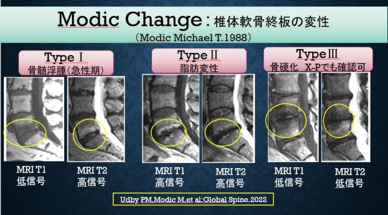 『腰痛患者の14％は椎体終板変性あり？～Modic change～』 | 運動器リハゼミ